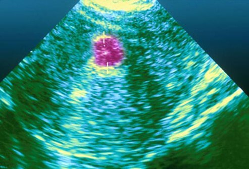 FIBROIDS | Vaatsalya Clinic